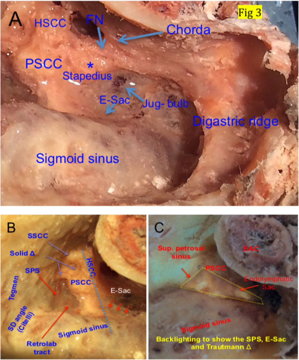 Temporal Bone Anatomy (Cadaveric Dissection) | Iowa Head and Neck Protocols - Carver College of ...